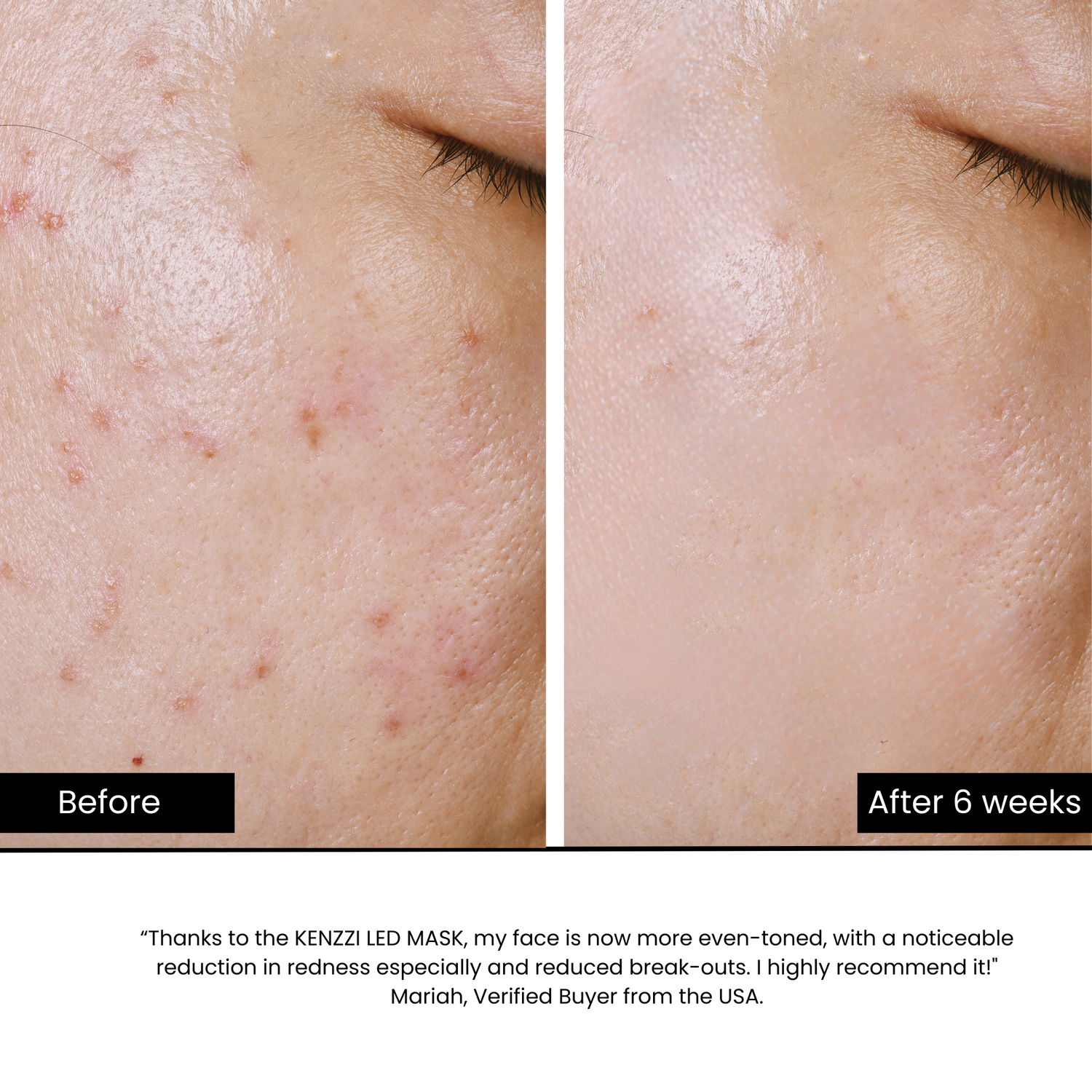 KENZZI LED Light Therapy Mask – Kenzzi